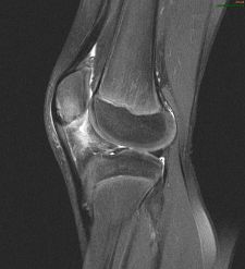 Morbus Sinding-Larsen-Johansson - Radiologische Praxis Vassilios ...